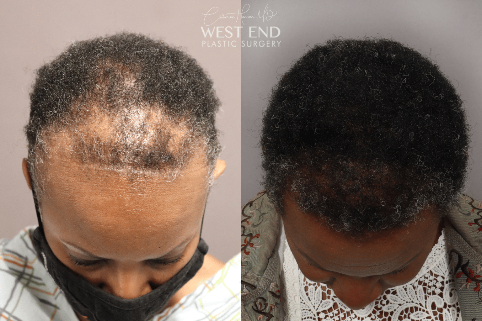NeoGraft® Hair-Transplantation for Women | West End Hair Center